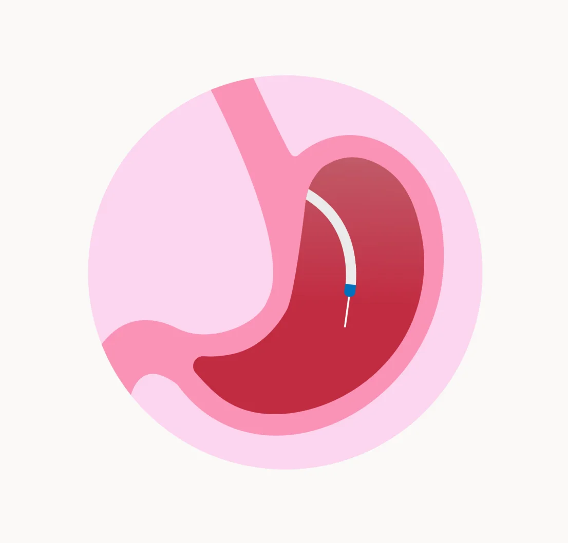 Intragastric Botox Injection for Non-Invasive Weight Management – Top ...